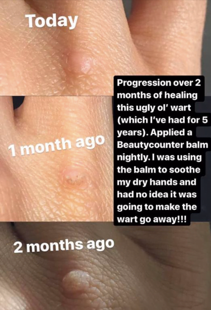 How to Use Apple Cider Vinegar to Remove Warts - Kelly the Kitchen Kop
